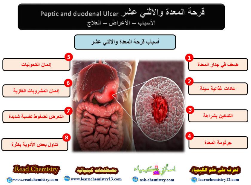 قرحة المعدة والاثني عشر Peptic and duodenal Ulcer | تعرف على علم الكيمياء